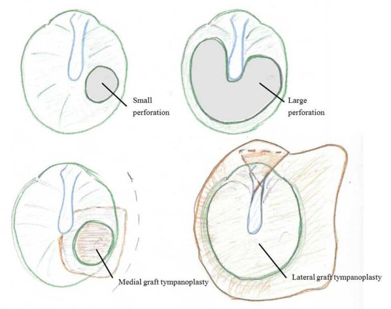 Surgery of the eardrum, middle ear and mastoid | Glacier Ear, Nose ...